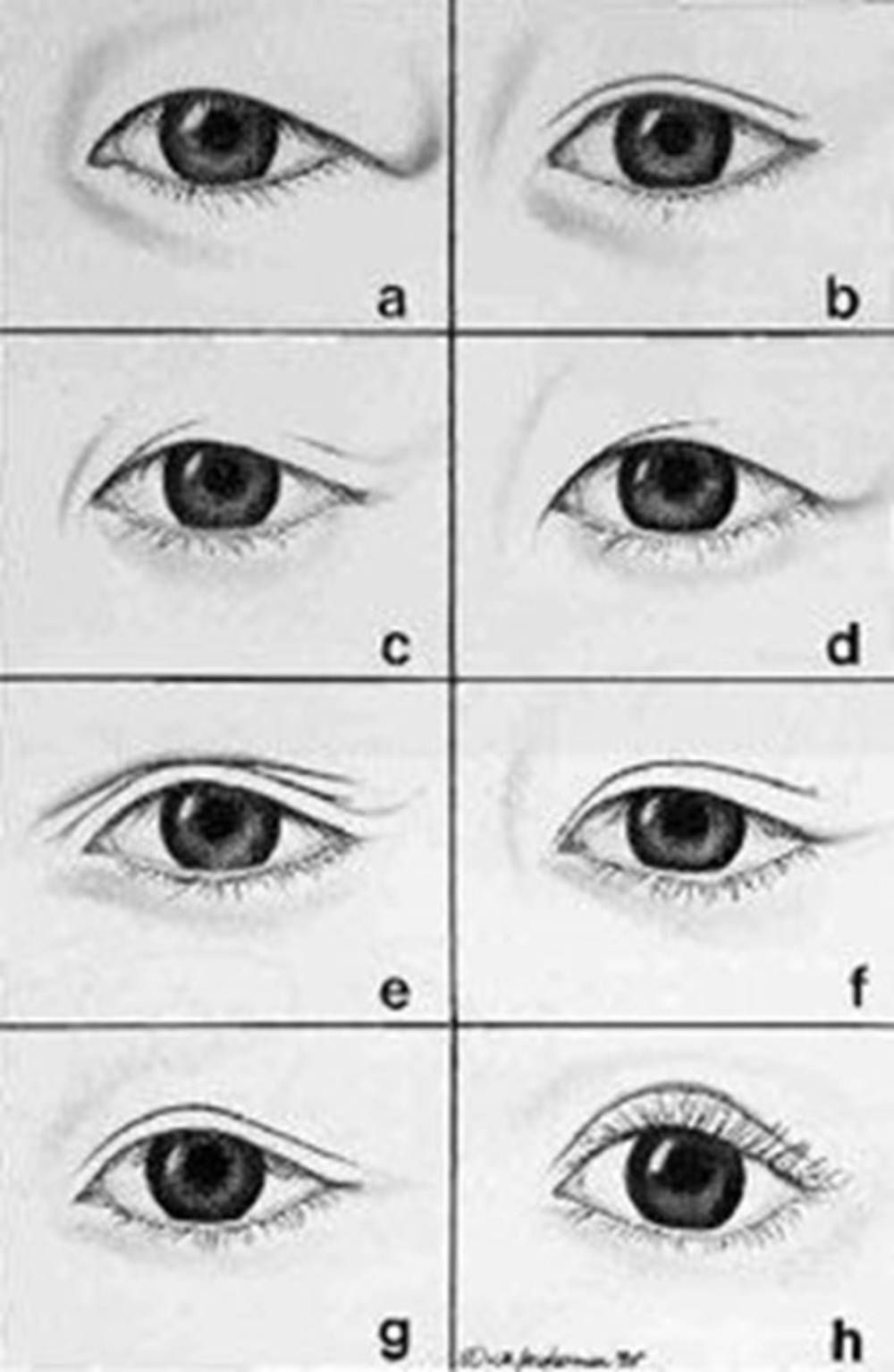 Asian Double Fold Surgery Asian Blepharoplasty Surgery