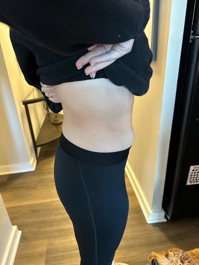 Patient 276015 Semaglutide Before And After Photos Images Med Spa