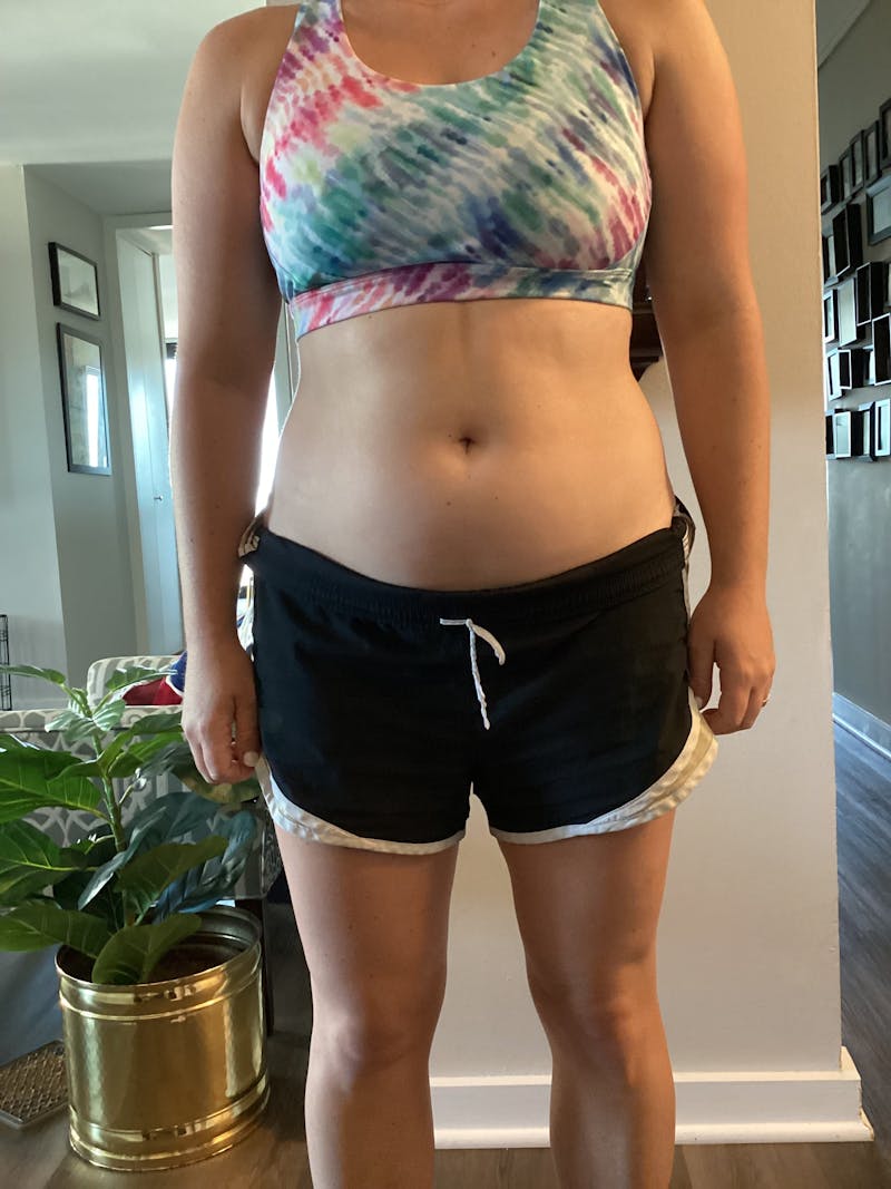 Patient 276015 Semaglutide Before And After Photos Images Med Spa