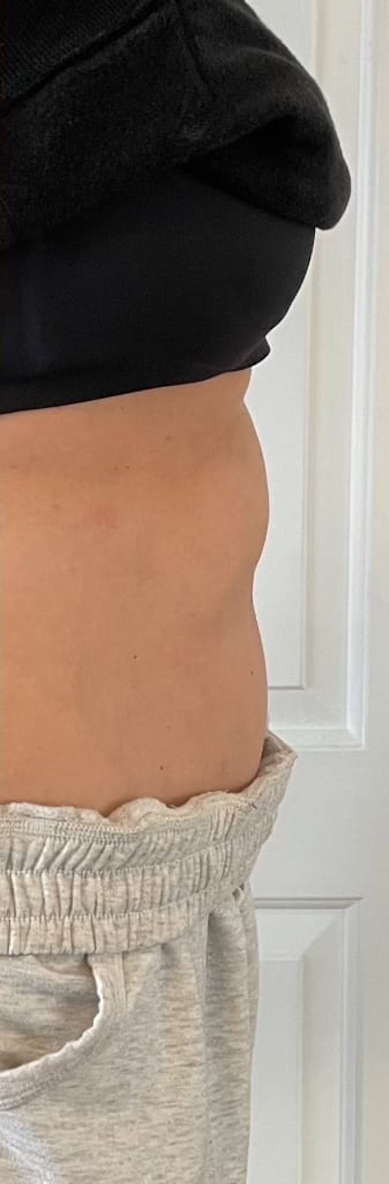 Patient 216509 Semaglutide Before And After Photos Images Med Spa