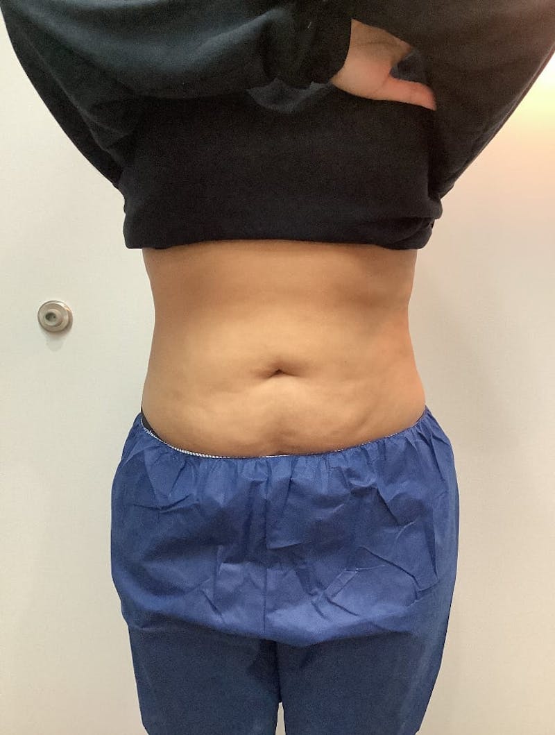 Patient 212528 Semaglutide Before And After Photos Images Med Spa