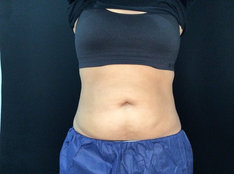 Patient 212528 Semaglutide Before And After Photos Images Med Spa