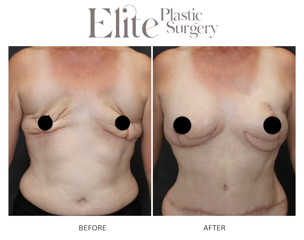 Patient 395041 | DIEP Breast Reconstruction Before & After Photos | Elite Plastic Surgery