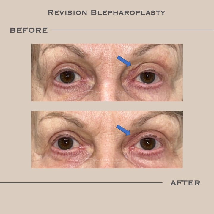 Blepharoplasty revision store