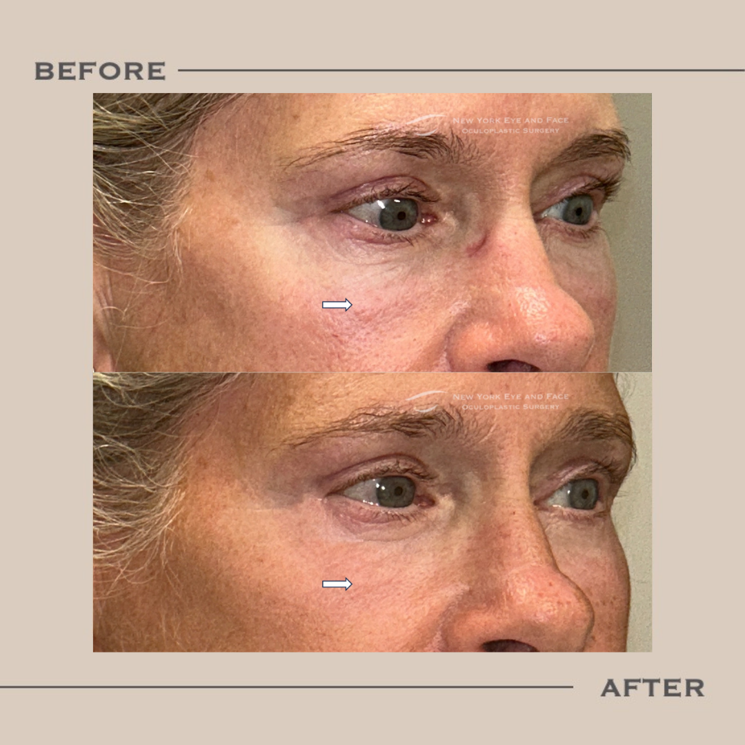 Festoon Treatment - West Harrison, NY | Festoon Treatment in Westchester
