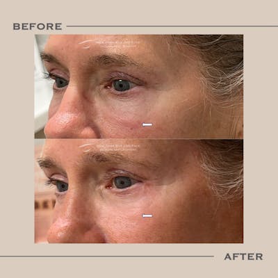 AcuPulse CO2 Laser Before & After Photos | New York Eye and Face ...