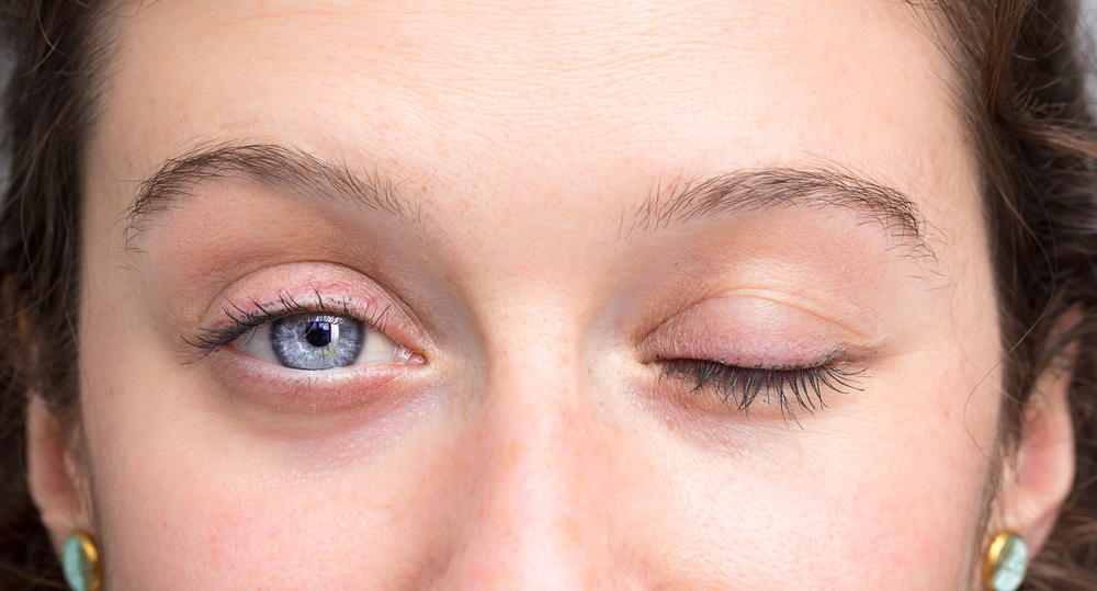 The Challenges of Eye Complications in Bell's Palsy | Pasadena, CA