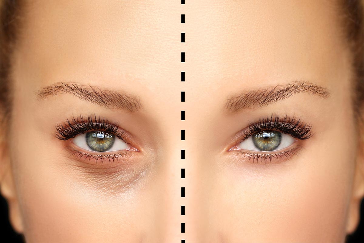 Healing Process After Lower Eyelid Surgery Timeline of Recovery