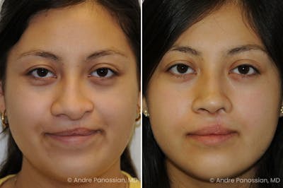 Revision Rhinoplasty Before & After Photos | Andre Panossian, M.D.