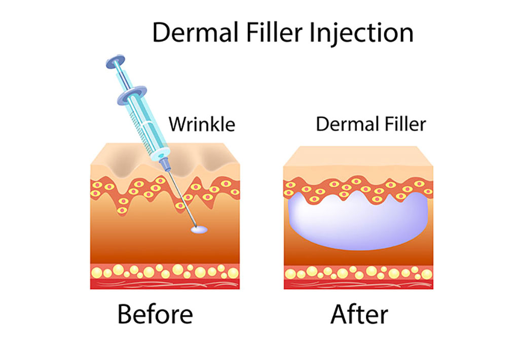 Dermal Fillers in Pasadena & Glendale | Andre Panossian, M.D.