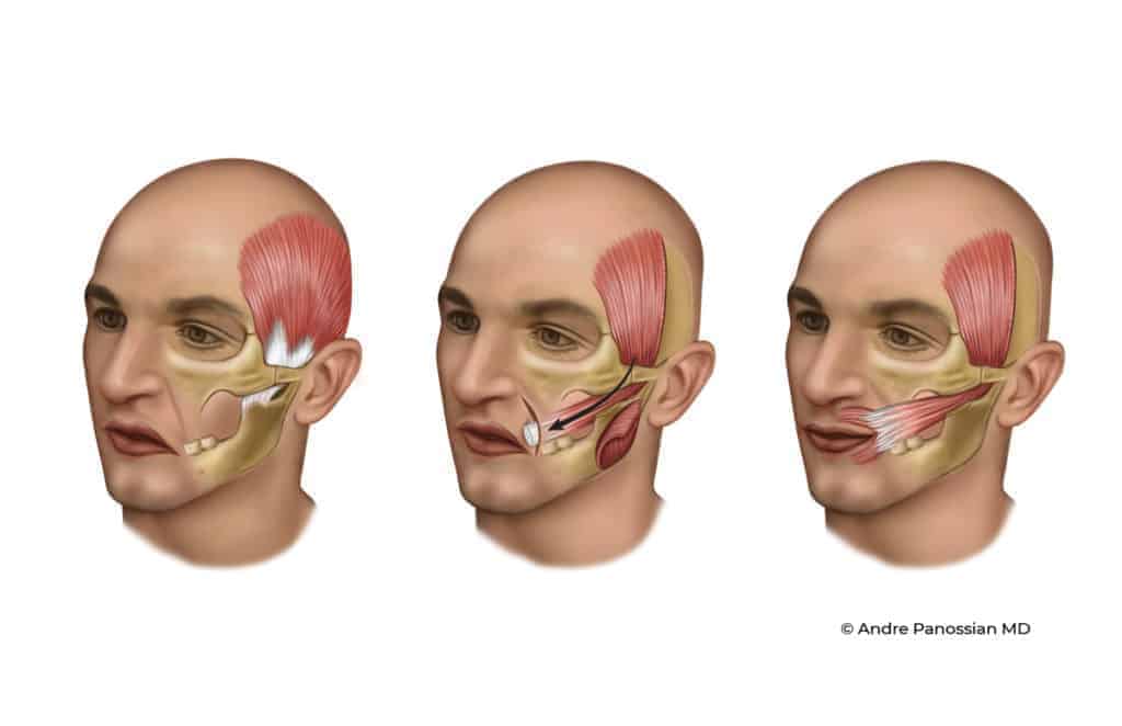 Temporalis Myoplasty in Pasadena & Glendale | Andre Panossian, M.D.