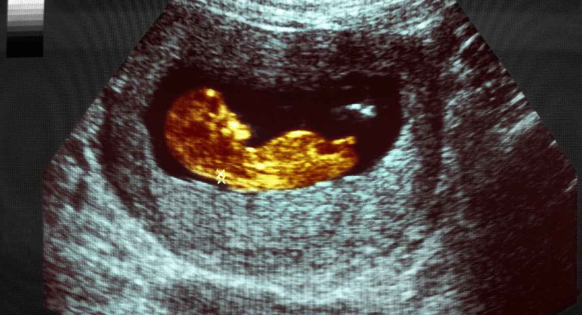 Coalition seeks to be allowed to defend Wyoming’s pro-life law | Live ...