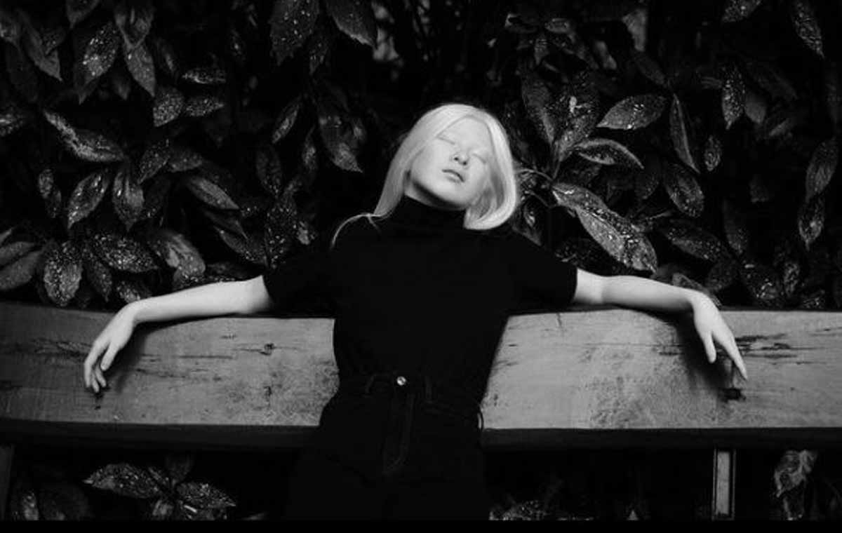 Chinese model with albinism was once an abandoned baby. Now she’s an ...