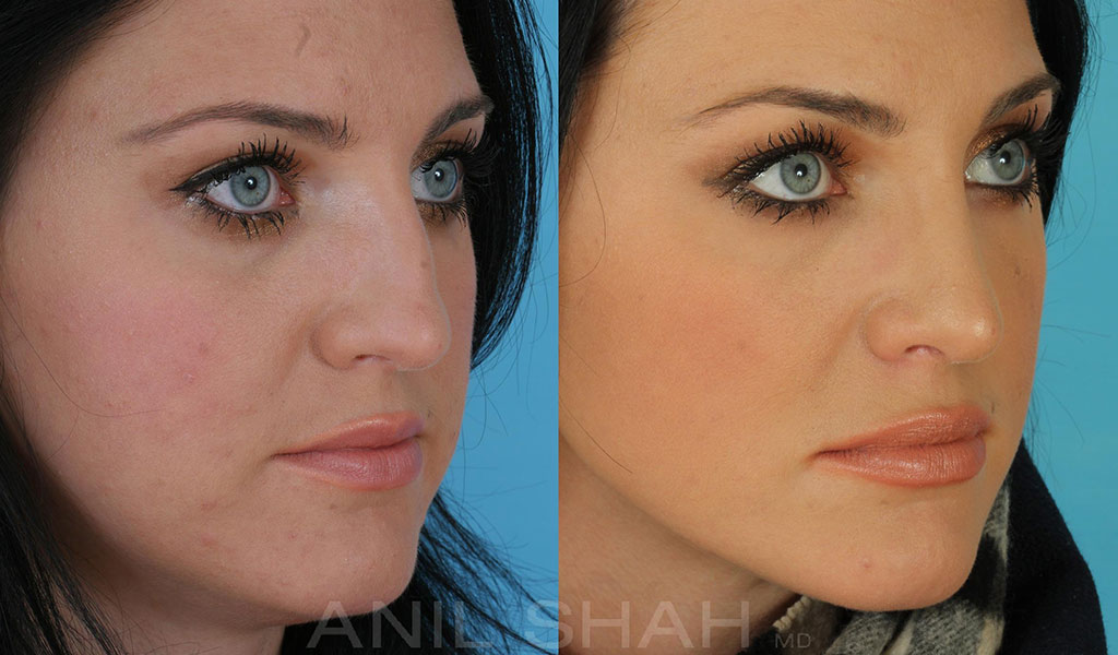 Importance of Video Before and After Plastic Surgery | Dr Anil Shah