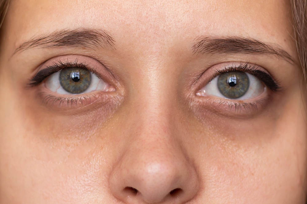 Recovering from Lower Blepharoplasty: What You Need to Know
