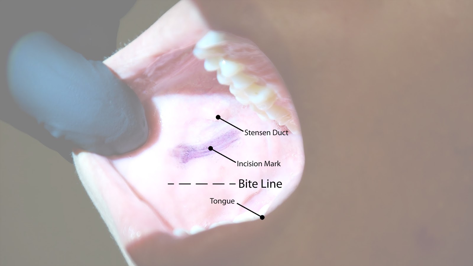 Buccal Fat Removal | Chicago, IL | Dr. Anil Shah