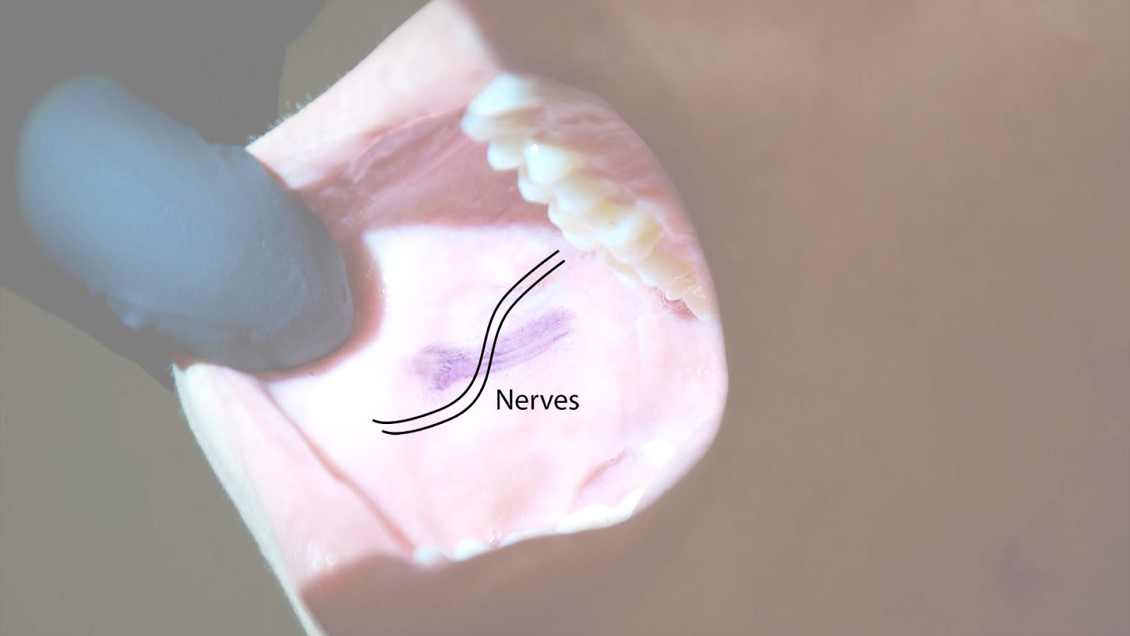 Buccal Fat Removal | Chicago, IL | Dr. Anil Shah