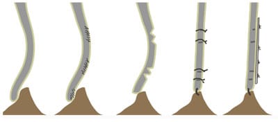 Septoplasty | Chicago, IL | Dr. Anil Shah