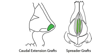 Septoplasty | Chicago, IL | Dr. Anil Shah
