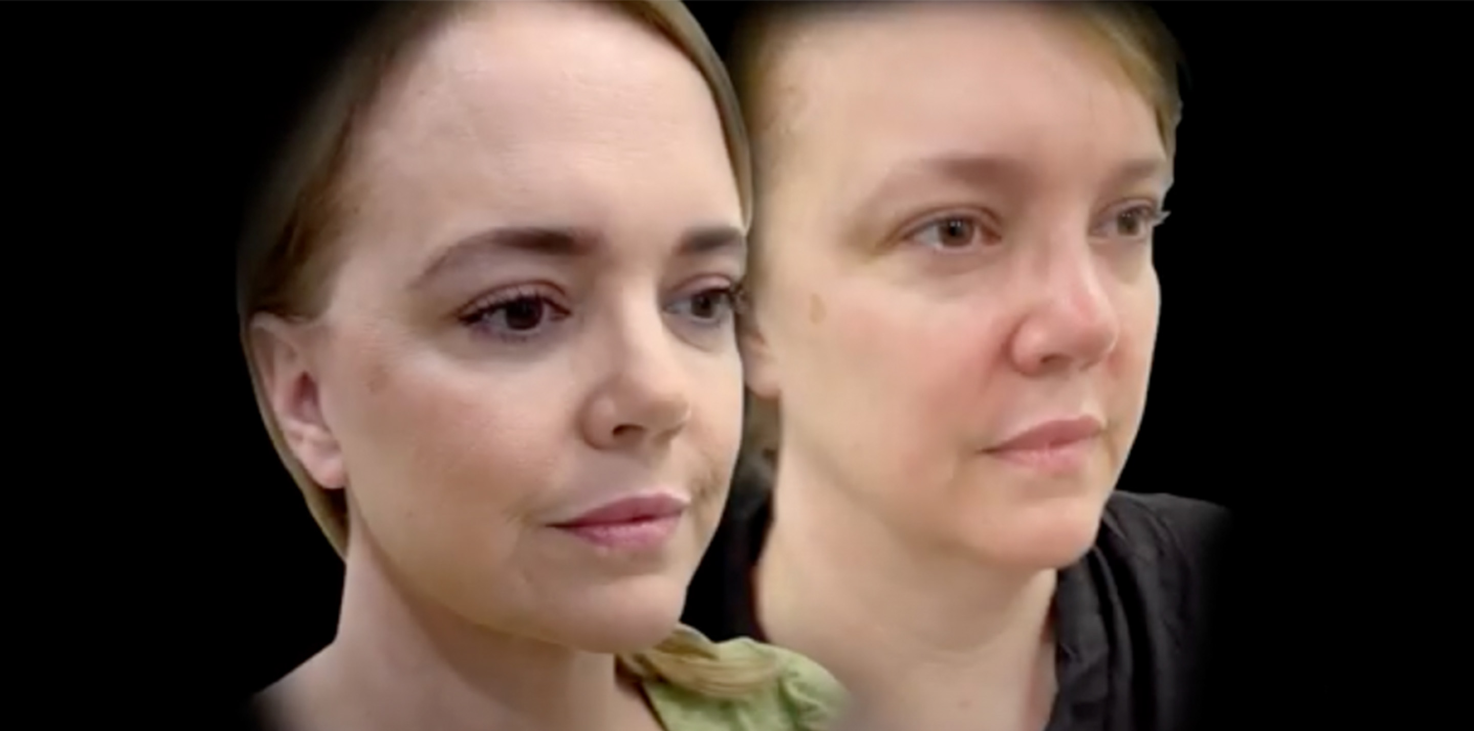 Aging Face Before & After Photos | Dr. Anil Shah