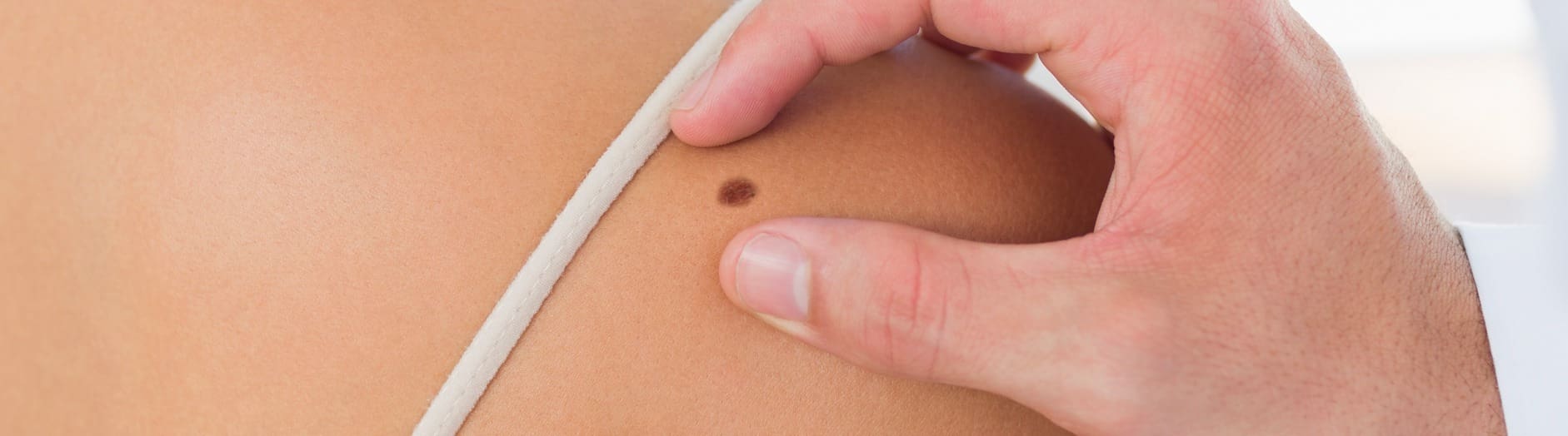 How to Spot Local Skin Cancer | APDerm