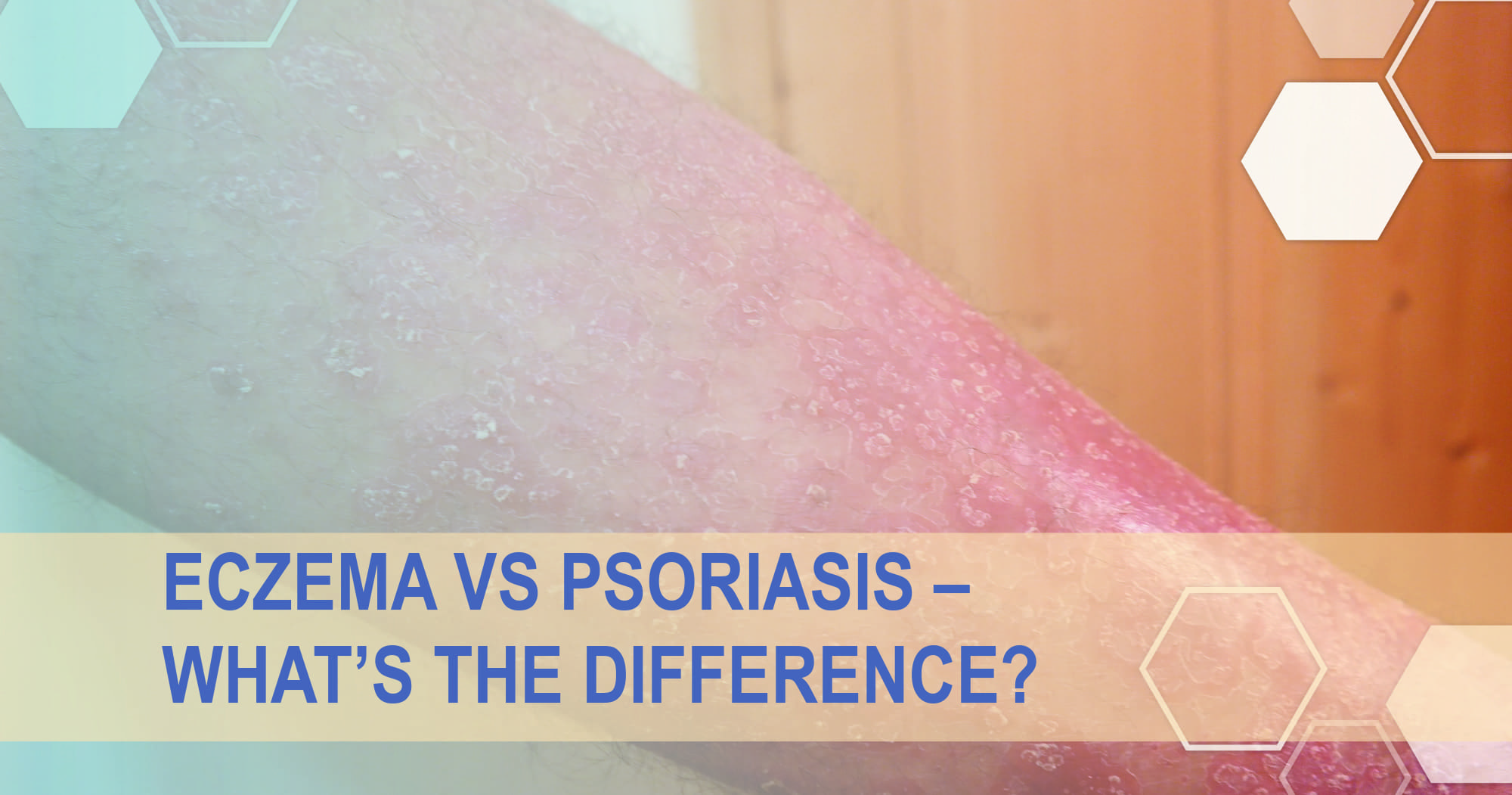 What Is The Difference Between Eczema and Psoriasis | APDerm