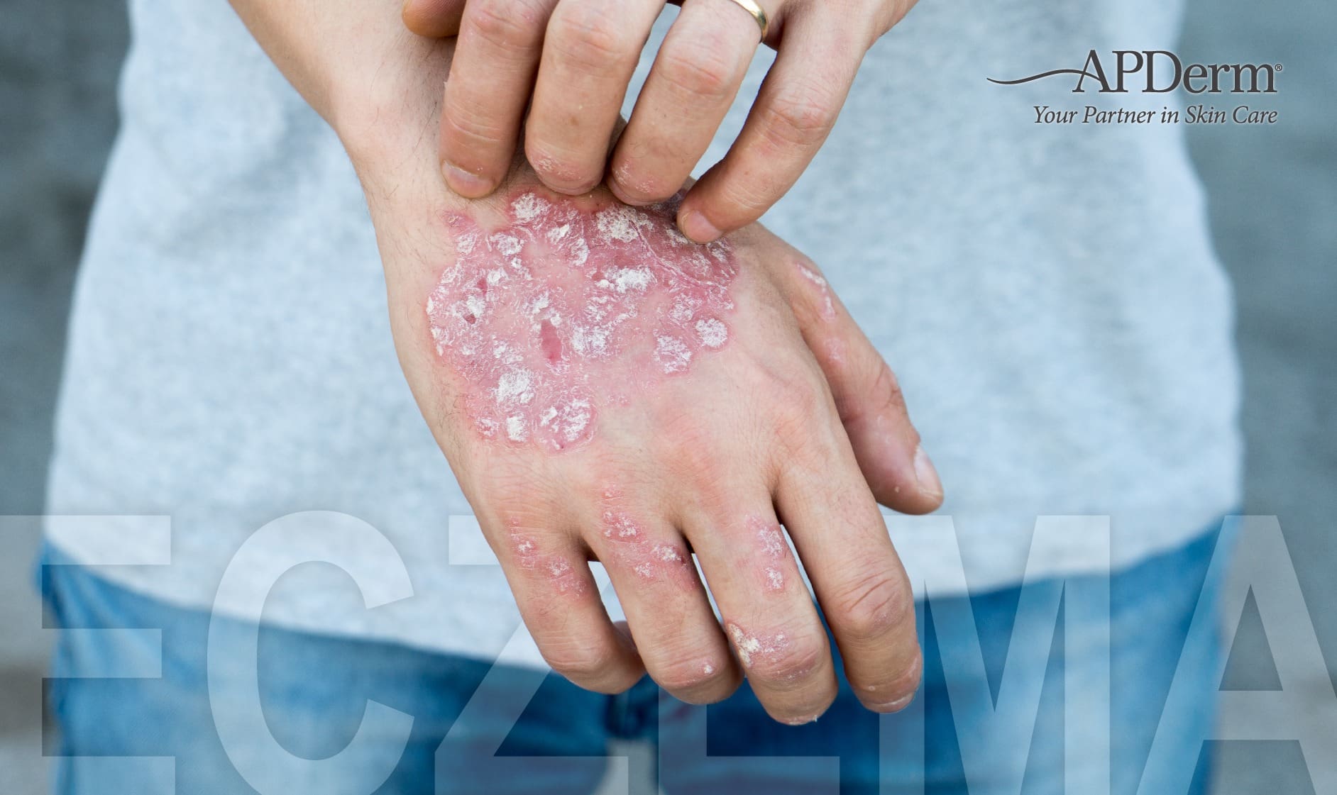 What Does Eczema Look Like | APDerm