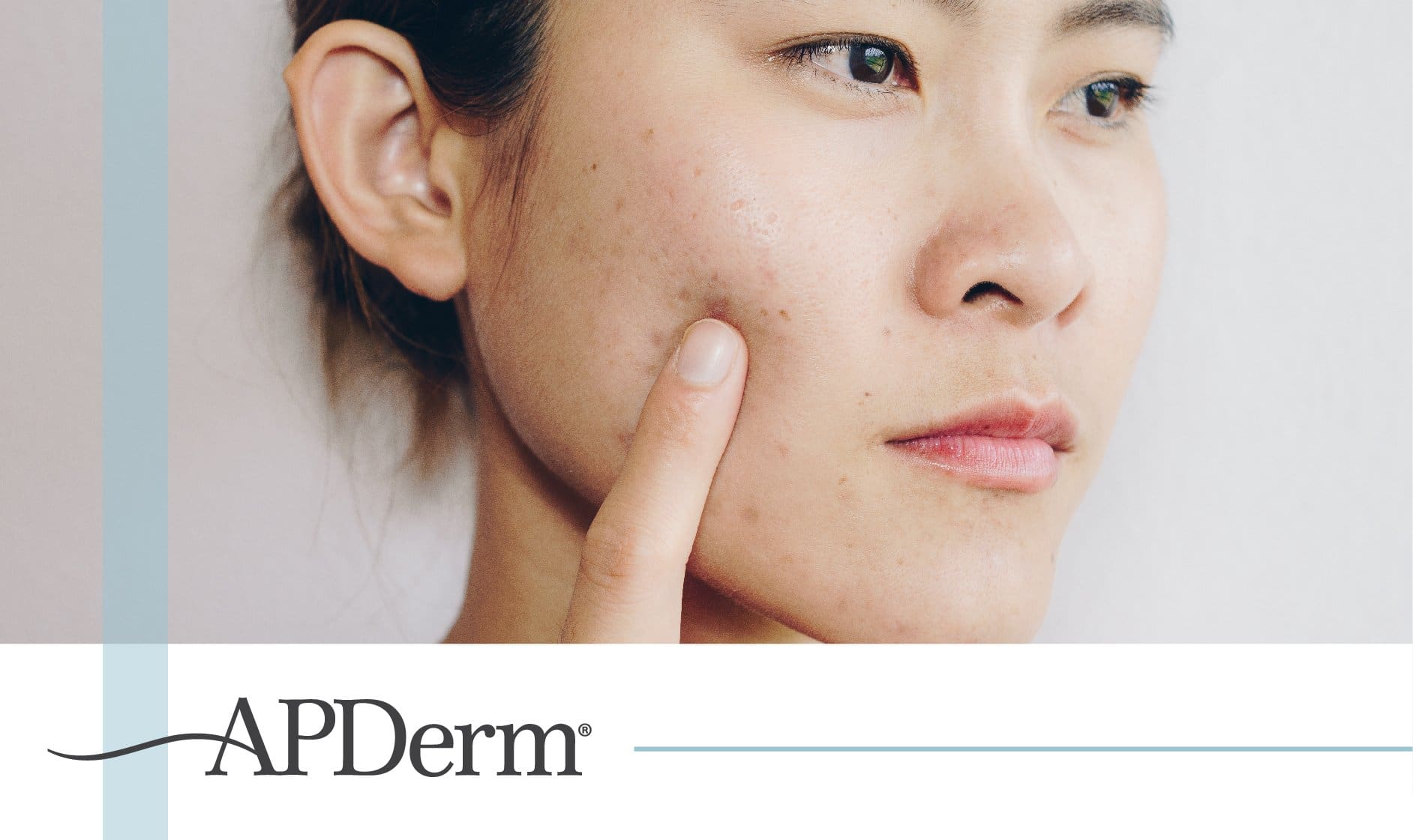 How To Remove Acne Scars | APDerm