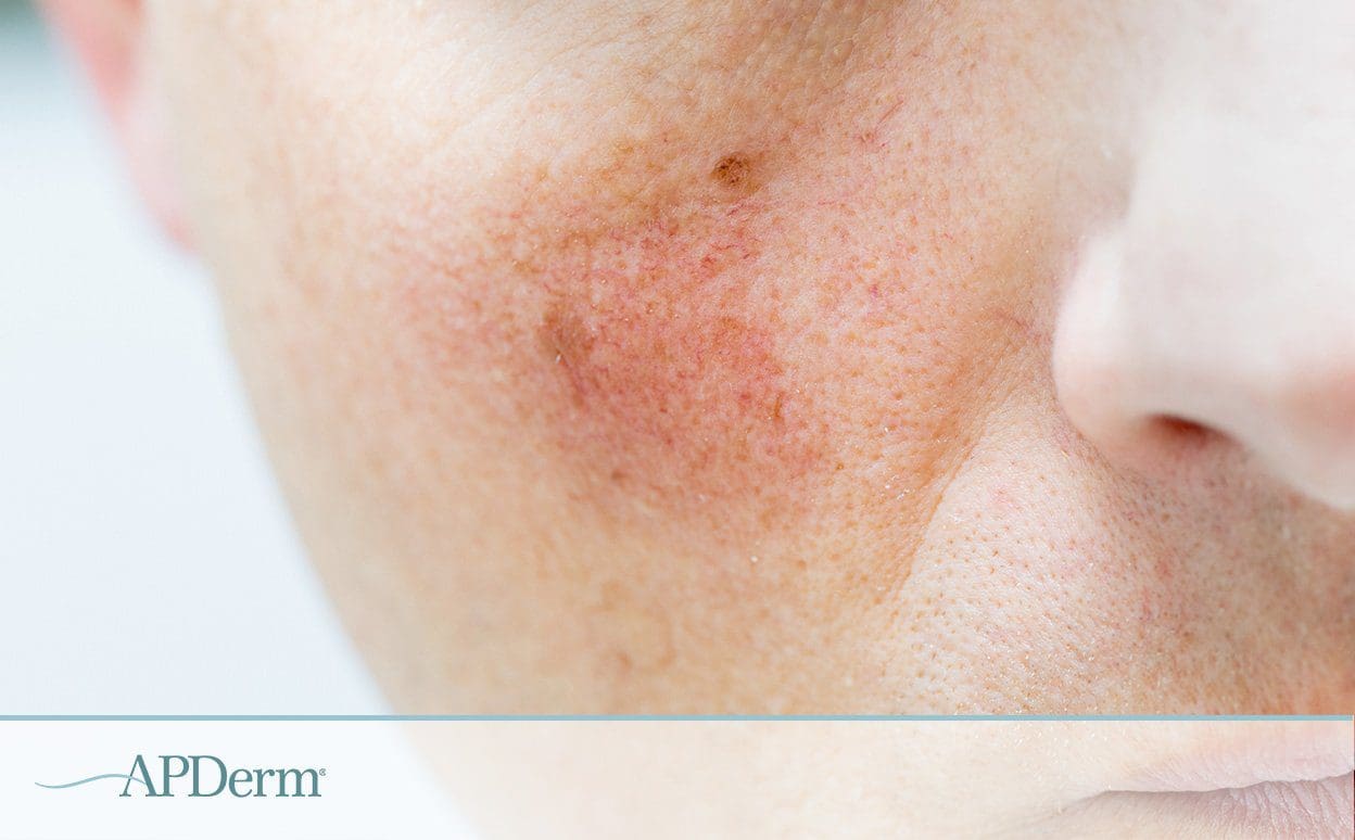 How to Treat Rosacea | APDerm