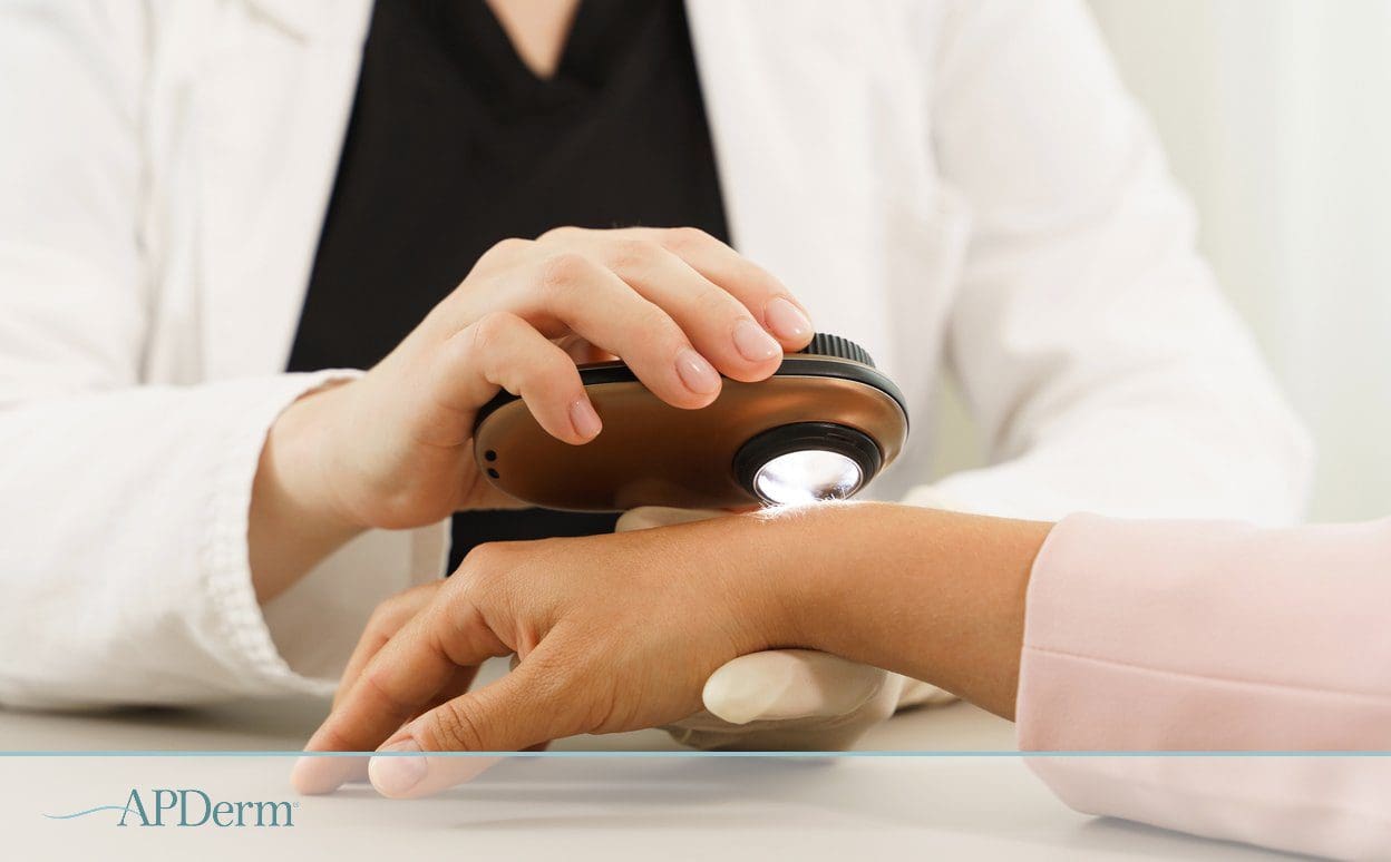 What are skin tags and how can they be prevented and removed?