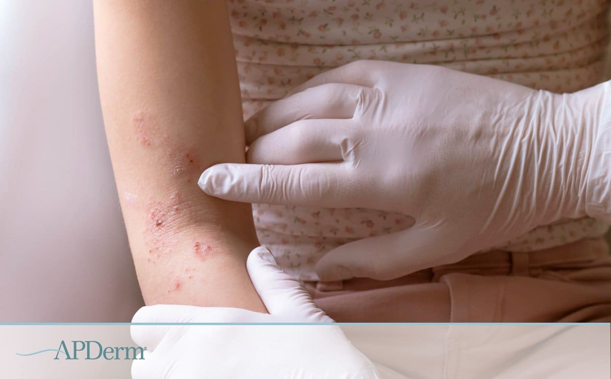Tips for relief when you're struggling with seasonal eczema