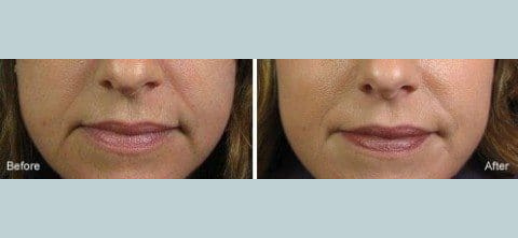 Cosmetic Injectables / Fillers: Various Treatments To Reduce Facial ...