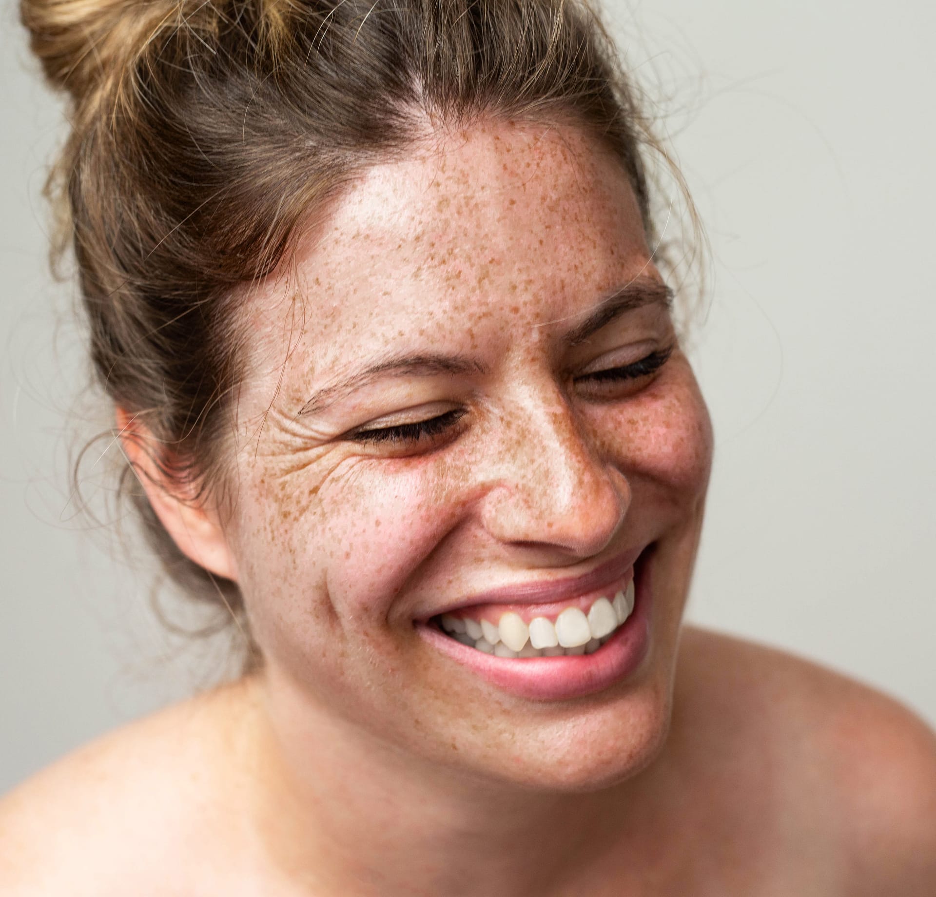 Melasma + Freckles | Neem Medical Spa