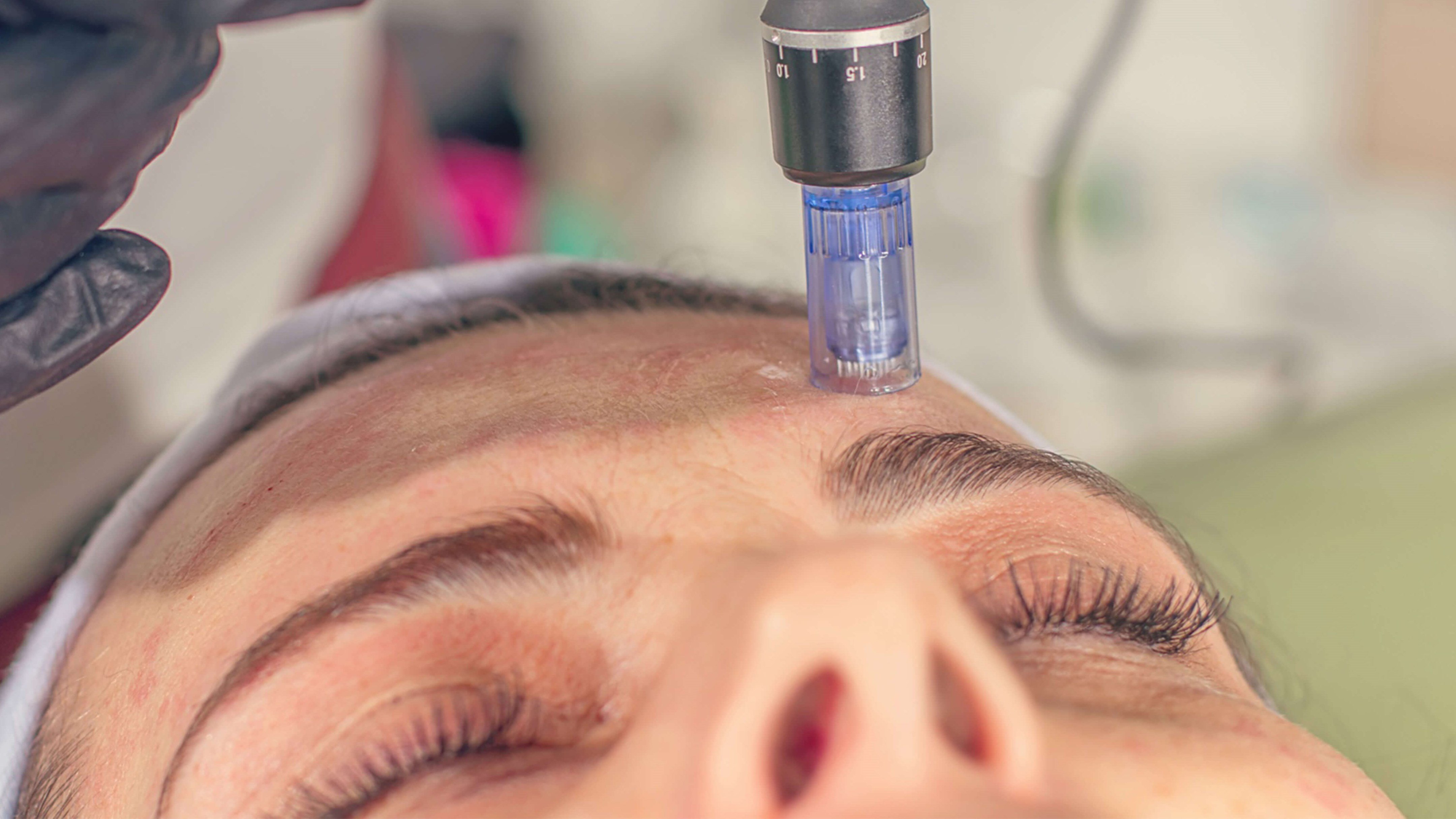What Is The Optimal Care For Skin After Micro-Needling?