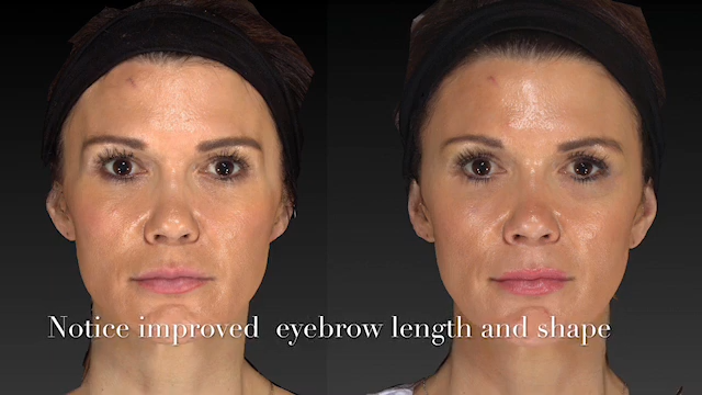 Facial Fillers | Refreshed Aesthetic Surgery & SkinCare