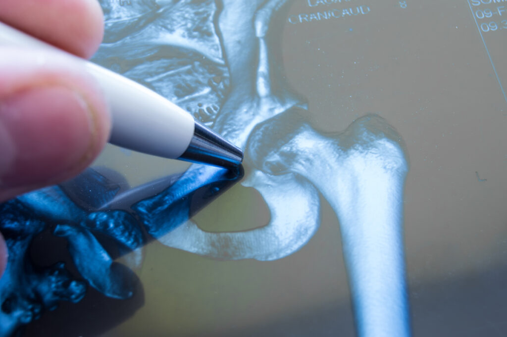 How Many People Are Affected by the Exactech Hip Replacement Recall ...