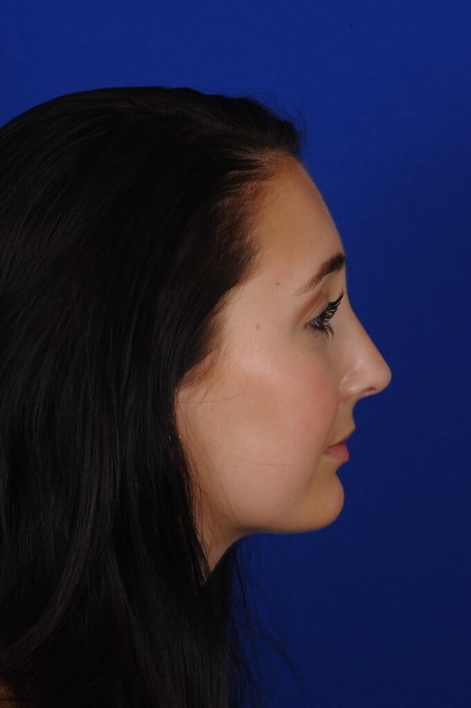 Patient 291999 | Septoplasty Before & After Photos | Matthew Bridges, MD