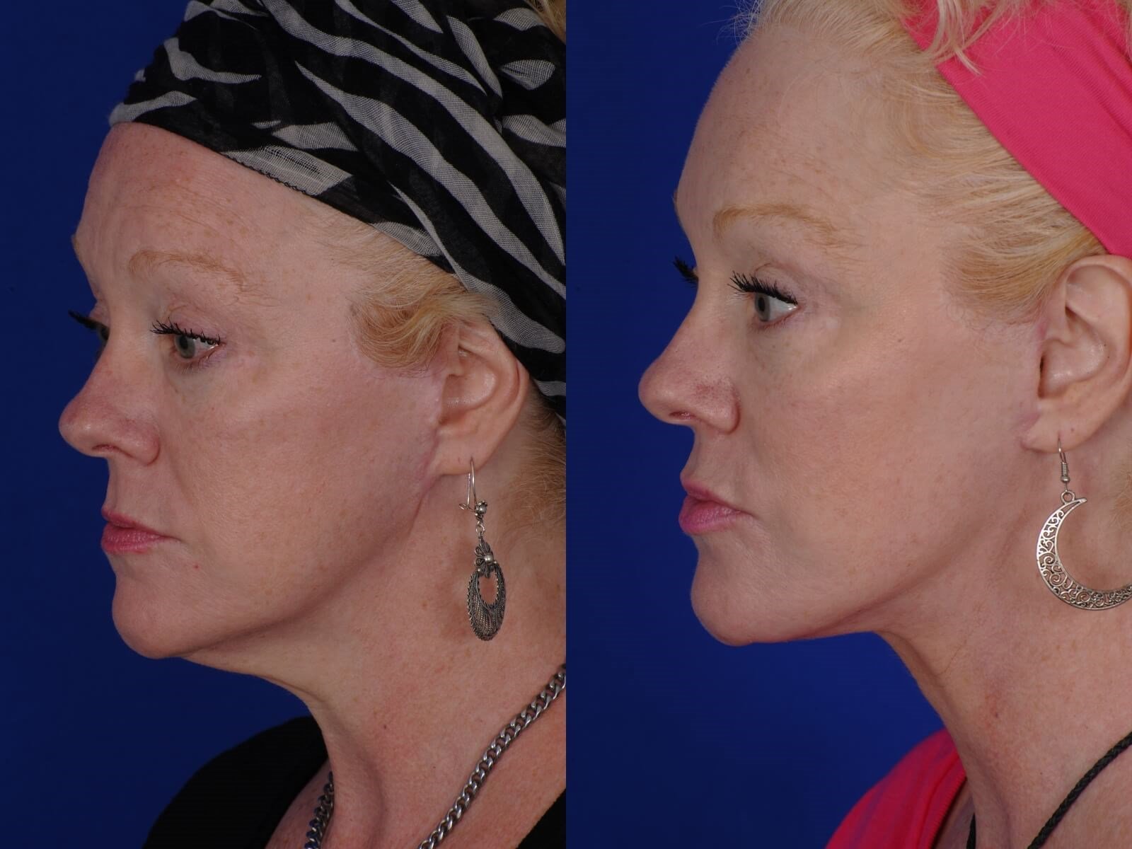 Patient 156938 | Scar Revision Before & After Photos | Matthew Bridges, MD