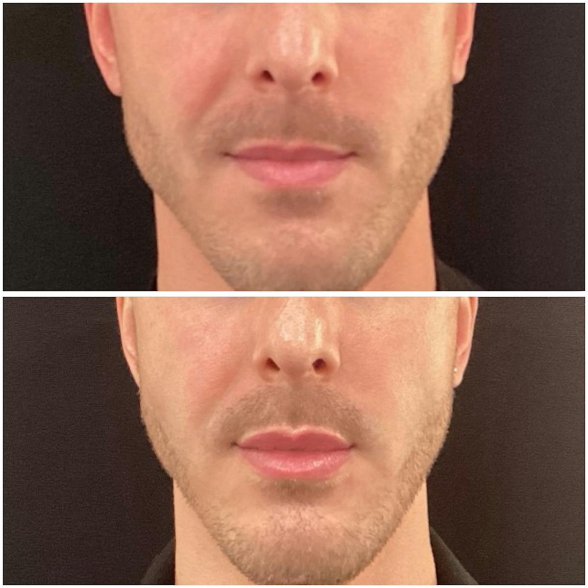Patient 162092 | Fillers Before & After Photos | Fulcrum Aesthetics