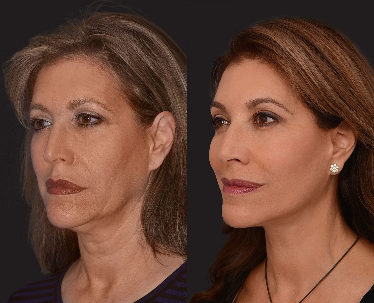 Facial Plastic Surgery Manhattan | NYC Facial Plastic Surgeon