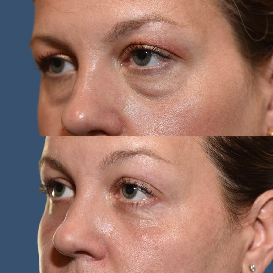 Lower Blepharoplasty Before & After Photos | Morgenstern Clinic