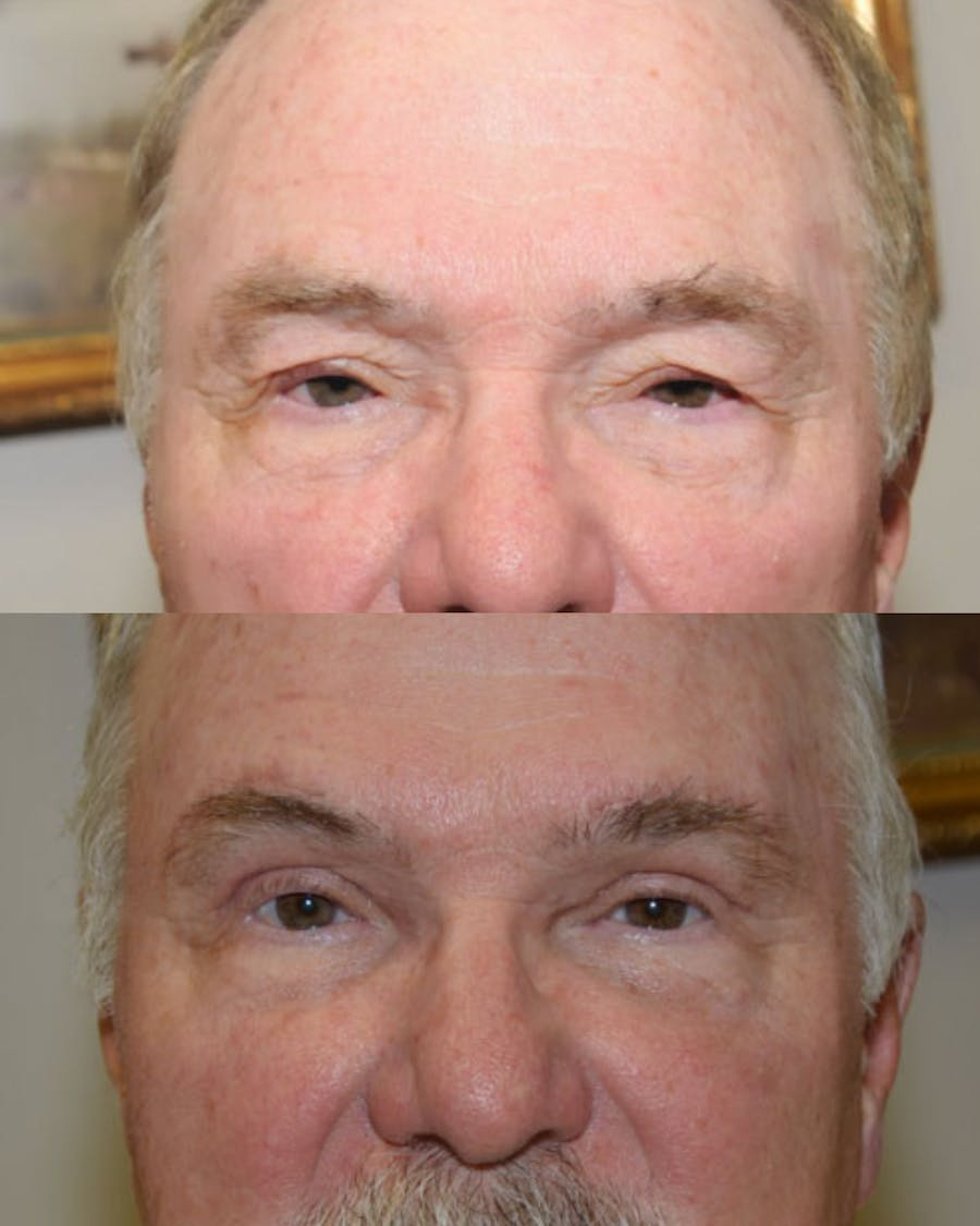 Direct Brow Lift Before & After Photos | Morgenstern Center