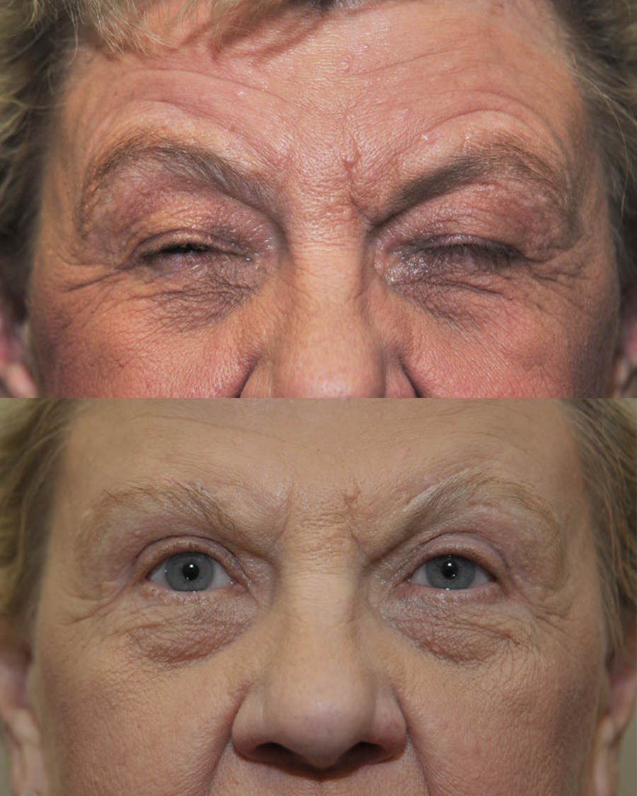Direct Brow Lift Before & After Photos | Morgenstern Center