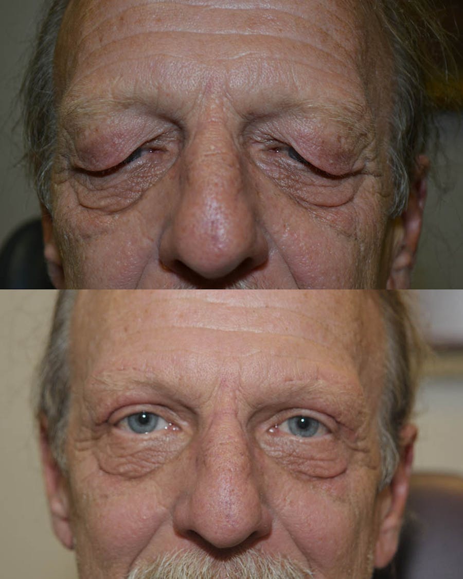 Direct Brow Lift Before & After Photos | Morgenstern Center