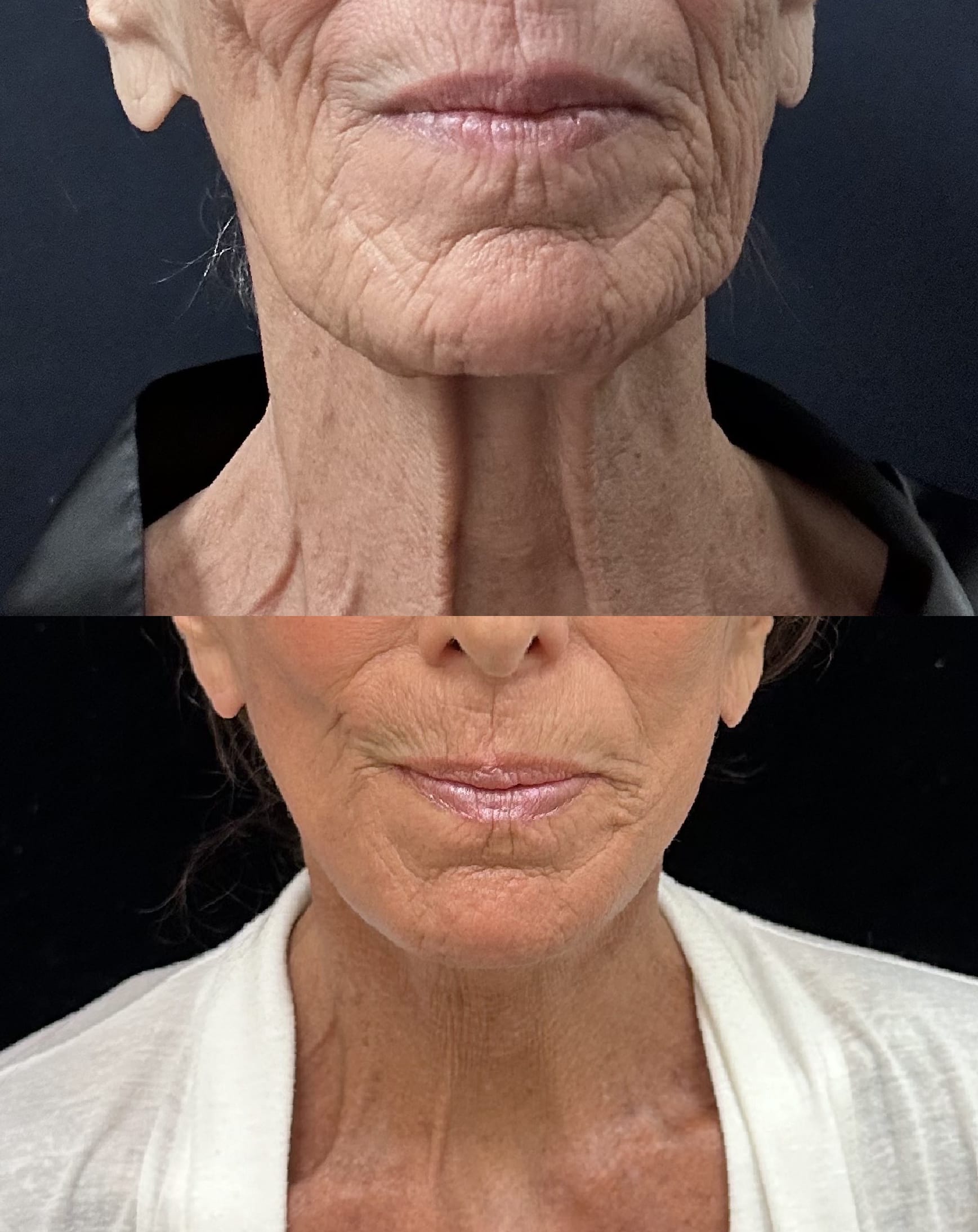 CO2 Laser Face Resurfacing Before & After Photos | Mansher Singh, MD