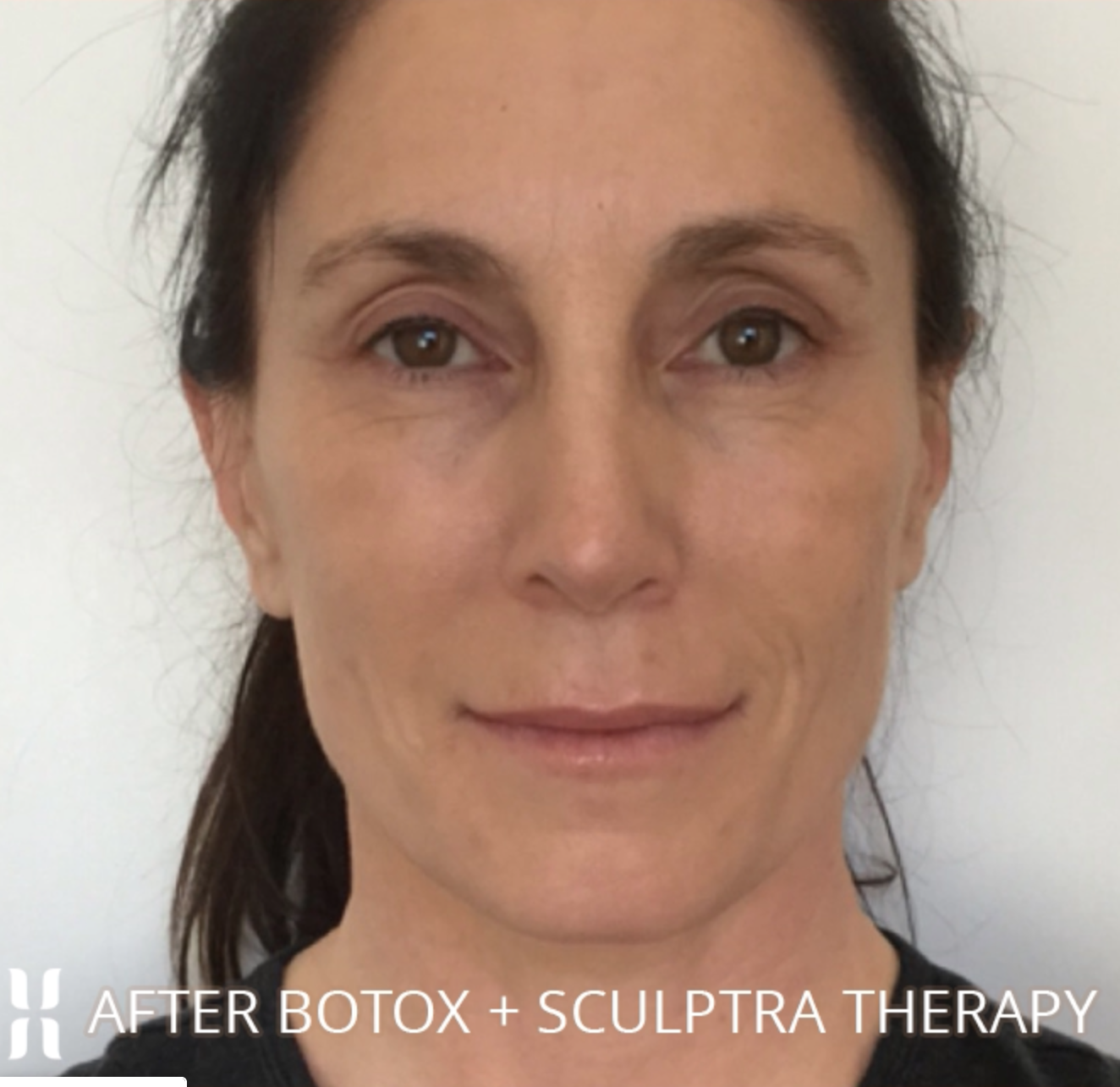 BOTOX in San Francisco | Hayes Valley Medical Esthetics