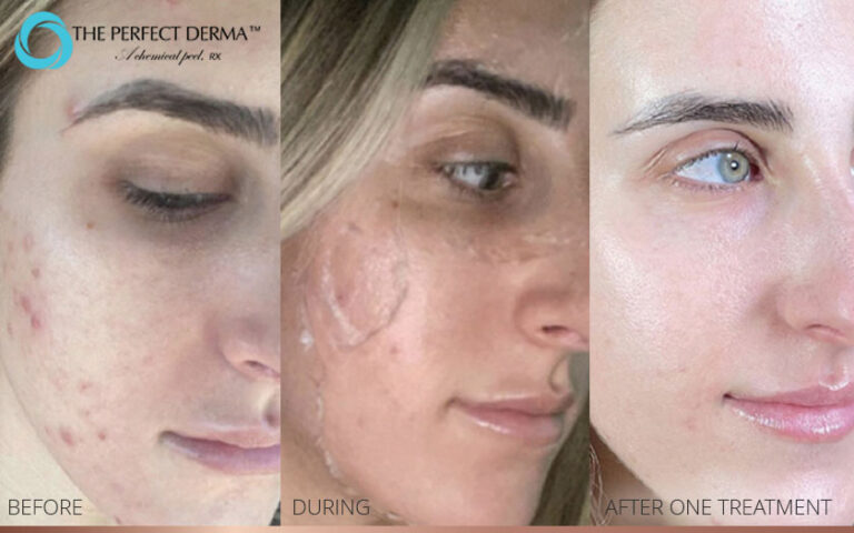 THE PERFECT DERMA PEEL RX AFTER-CARE