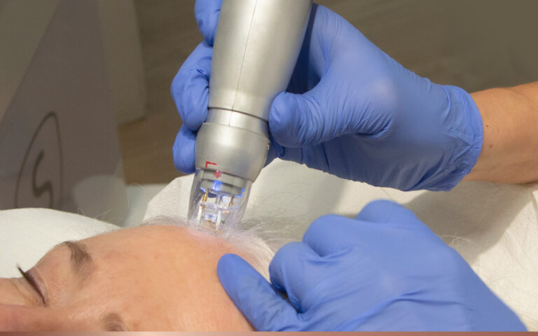 Morpheus8 vs Scarlet RF and Agnes RF Treatments