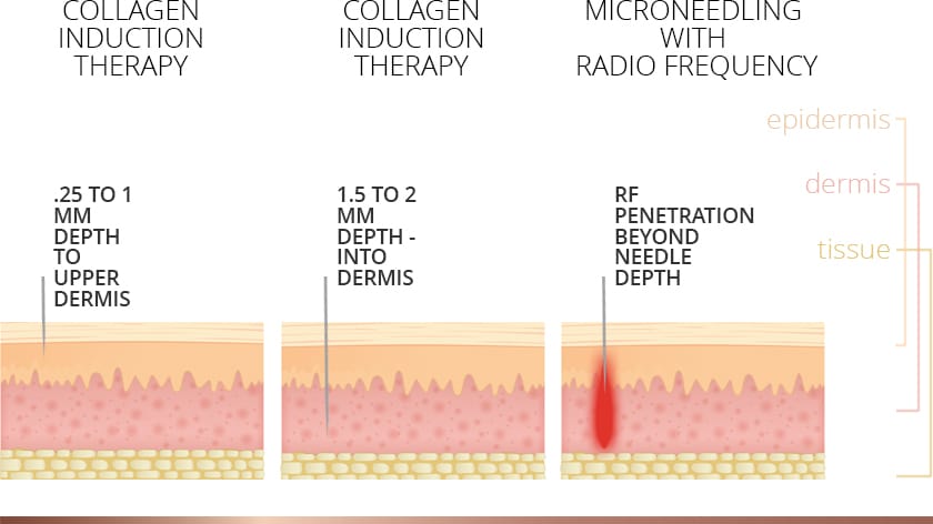 Microneedling Treatments Compared