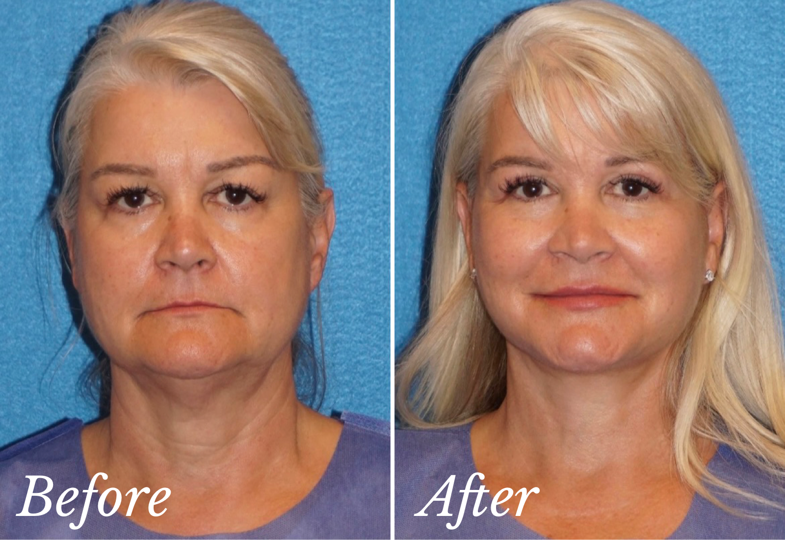 Facelift Before & After Photos | Westside Plastic Surgery